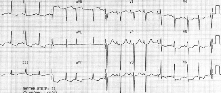 Dilated Cardiomyopathy (DCM) • LITFL • ECG Library Diagnosis