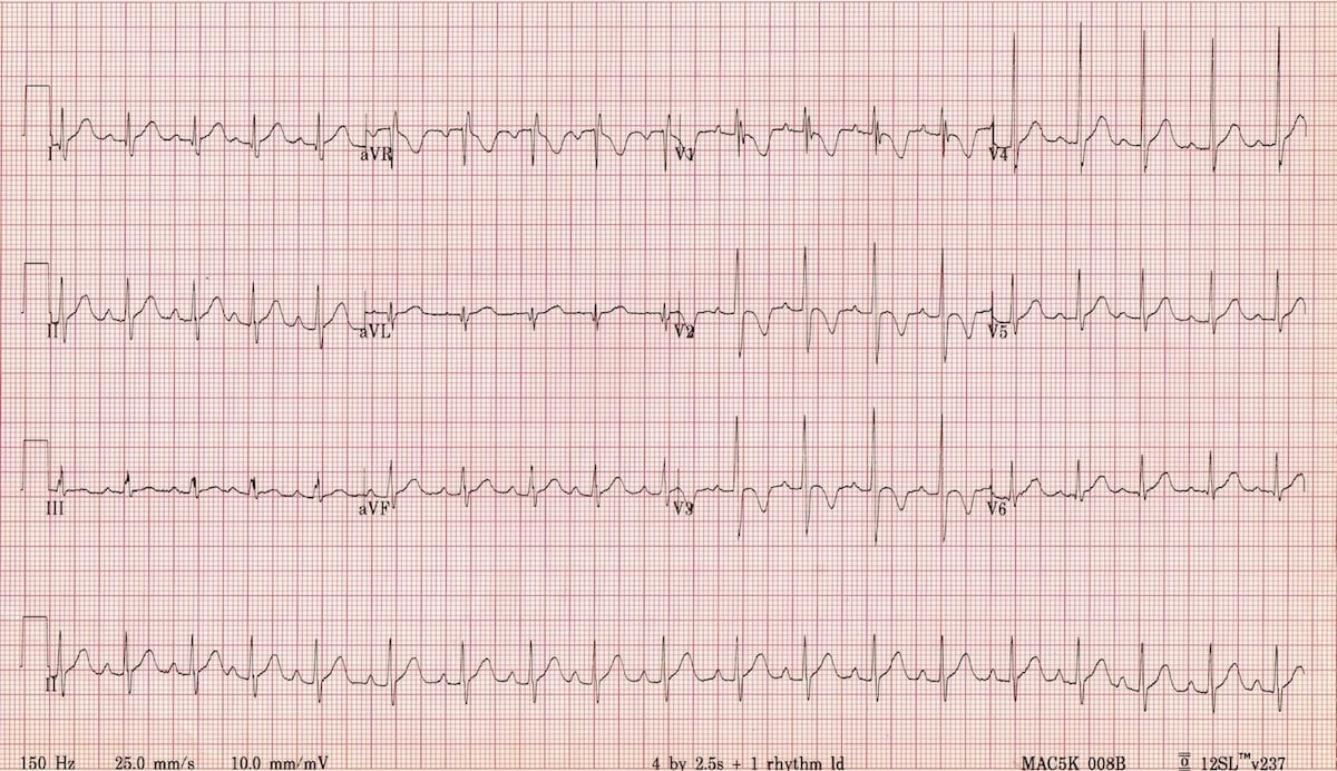 Normal Paediatric ECG LITFL ECG Library Diagnosis Normal Paediatric ECG LITFL ECG Library Diagnosis