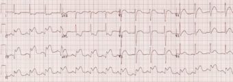 Inferior STEMI • LITFL • ECG Library Diagnosis