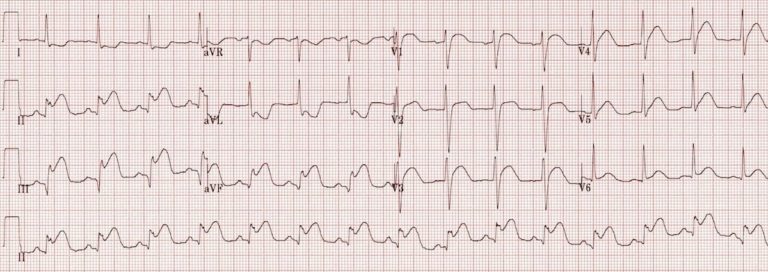 Inferior STEMI • LITFL • ECG Library Diagnosis