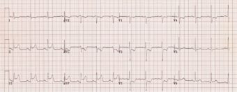 Inferior STEMI • LITFL • ECG Library Diagnosis