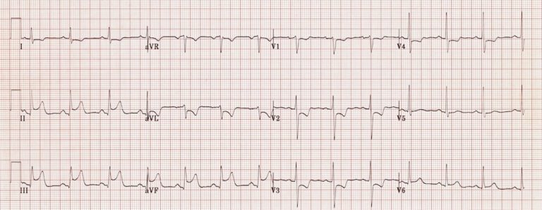Inferior STEMI • LITFL • ECG Library Diagnosis
