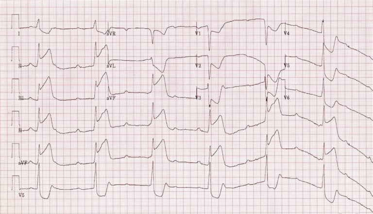 Inferior STEMI • LITFL • ECG Library Diagnosis