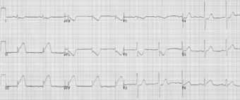Inferior STEMI • LITFL • ECG Library Diagnosis