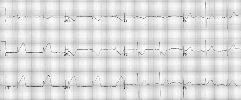 Inferior STEMI • LITFL • ECG Library Diagnosis