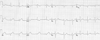 Inferior STEMI • LITFL • ECG Library Diagnosis