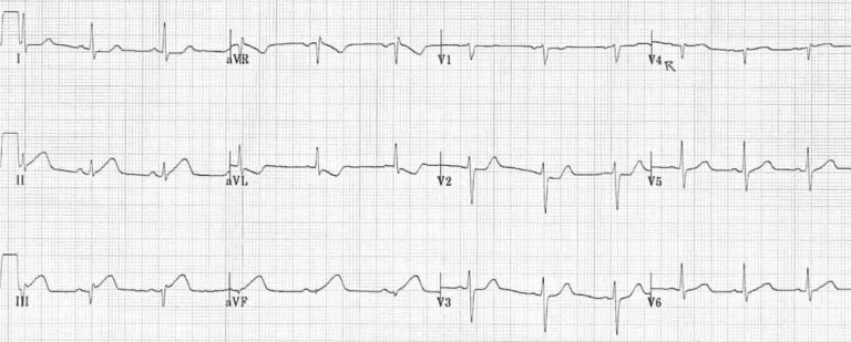 Inferior STEMI • LITFL • ECG Library Diagnosis