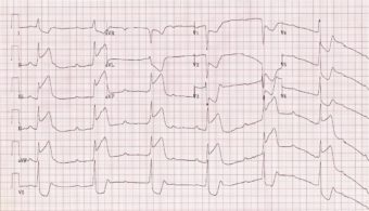 AV block: 3rd degree (complete heart block) • LITFL • ECG Library