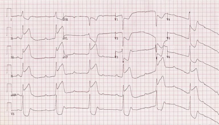 AV block: 3rd degree (complete heart block) • LITFL • ECG Library AV block: 3rd degree (complete heart block) • LITFL • ECG Library