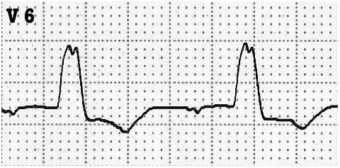 VT versus SVT • LITFL Medical Blog • ECG Library Basics