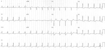 PR Interval • LITFL • ECG Library Basics