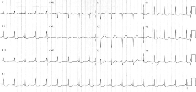 PR Interval • LITFL • ECG Library Basics