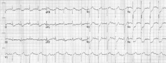 ST Elevation in aVR • LITFL • ECG Library Diagnosis