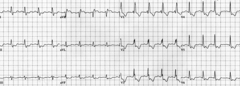 ST Elevation in aVR • LITFL • ECG Library Diagnosis