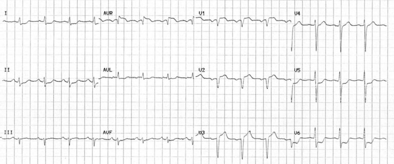 ST Elevation in aVR • LITFL • ECG Library Diagnosis