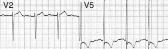 Left Ventricular Hypertrophy (LVH) • LITFL • ECG Library Diagnosis