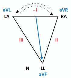 Lead reversal: Left arm/right arm • LITFL • ECG Library Diagnosis