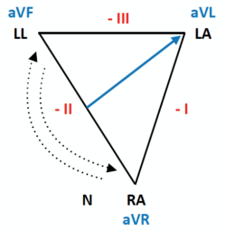 ECG Limb Lead Reversal • LITFL • ECG Library Diagnosis