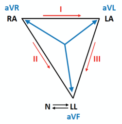 ECG Limb Lead Reversal • LITFL • ECG Library Diagnosis