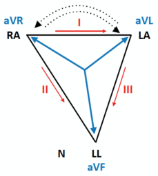 ECG Limb Lead Reversal • LITFL • ECG Library Diagnosis