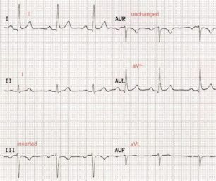ECG Limb Lead Reversal • LITFL • ECG Library Diagnosis