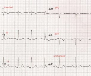 ECG Limb Lead Reversal • LITFL • ECG Library Diagnosis