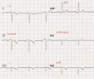 ECG Limb Lead Reversal • LITFL • ECG Library Diagnosis