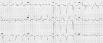 The ST Segment • LITFL • ECG Library Basics