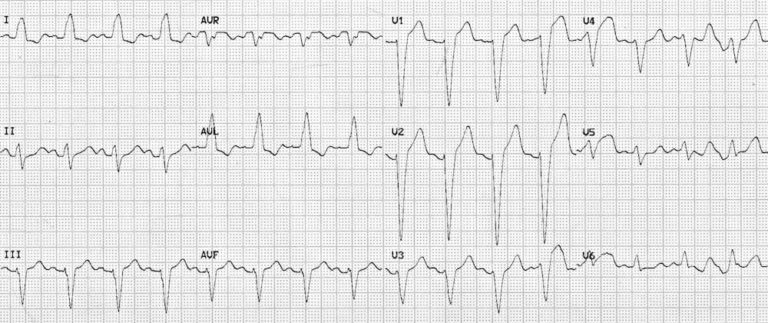 The ST Segment • LITFL • ECG Library Basics