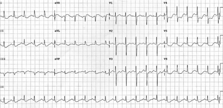 ST Elevation in aVR • LITFL • ECG Library Diagnosis