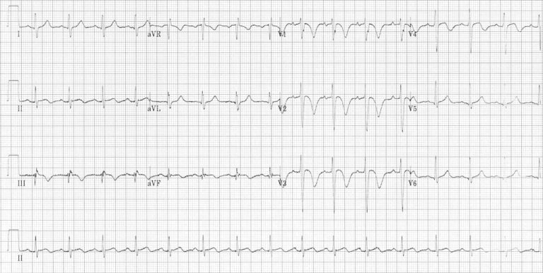 ECG changes in Pulmonary Embolism • LITFL • ECG Library