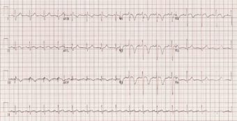 Right Ventricular Strain • LITFL • ECG Library Diagnosis