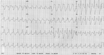 Tricyclic Overdose • LITFL • ECG Library