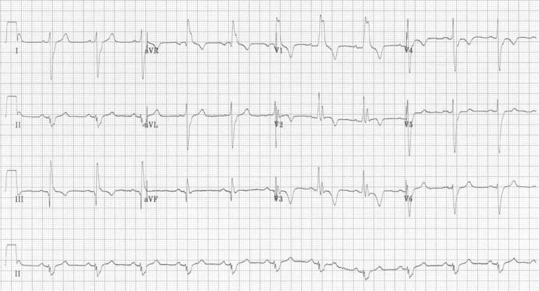ECG changes in Pulmonary Embolism • LITFL • ECG Library
