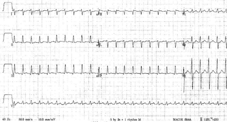 Common paediatric arrhythmias • LITFL • ECG Library Diagnosis