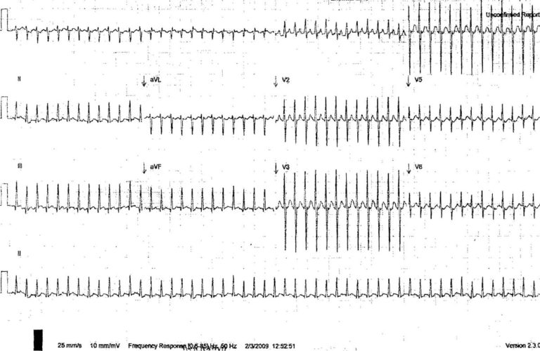 Paediatric ECG Interpretation • LITFL • ECG Library Basics Paediatric ECG Interpretation • LITFL • ECG Library Basics