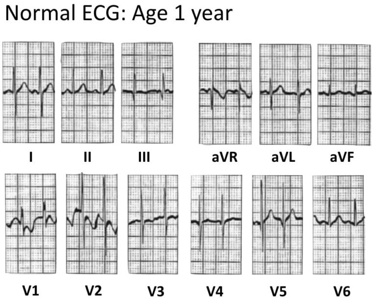 Normal paediatric ECG • LITFL • ECG Library Diagnosis