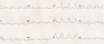 Anterior Myocardial Infarction • LITFL • ECG Library Diagnosis