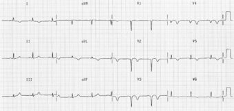 Poor R Wave Progression (PRWP) • LITFL • ECG Library Diagnosis