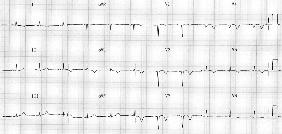 Poor R Wave Progression PRWP LITFL ECG Library Diagnosis