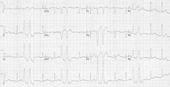 Premature Ventricular Complex (PVC) • LITFL • ECG Library Diagnosis