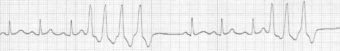 Premature Ventricular Complex (PVC) • LITFL • ECG Library Diagnosis