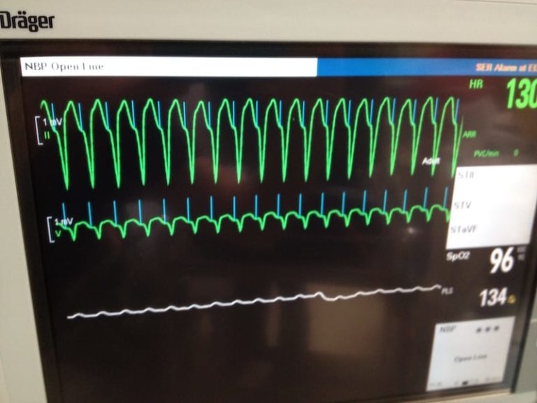 ECG Case 049 • LITFL • ECG Top 100 Self-Assessment Quiz