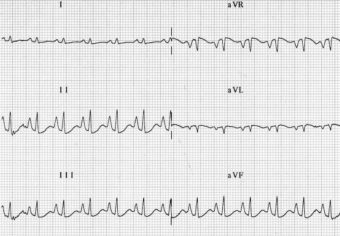 Right Atrial Enlargement • LITFL Medical Blog • ECG Library Basics
