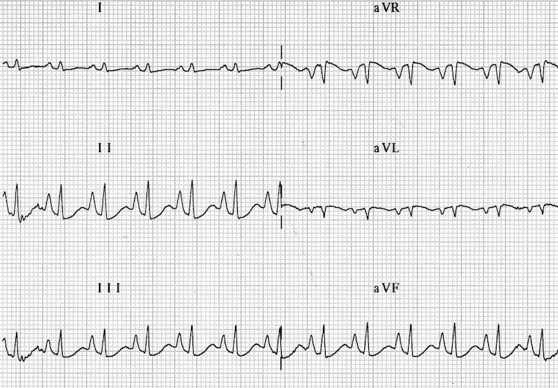 Right Atrial Enlargement LITFL Medical Blog ECG Library Basics Right Atrial Enlargement LITFL Medical Blog ECG Library Basics