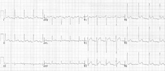 Pericarditis ECG Changes • LITFL • ECG Library Diagnosis