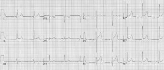 Pericarditis ECG Changes • LITFL • ECG Library Diagnosis