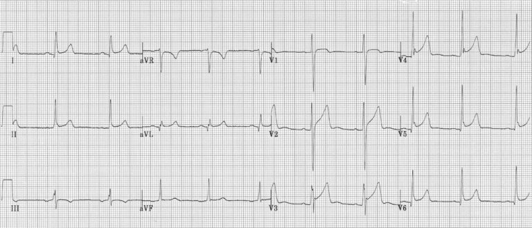 Pericarditis ECG Changes • LITFL • ECG Library Diagnosis