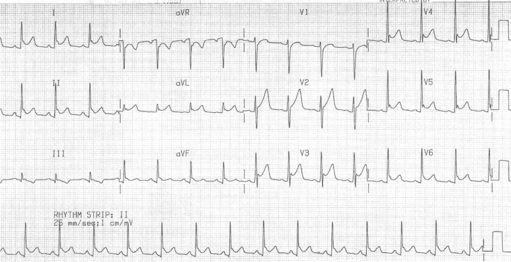 Benign Early Repolarisation • LITFL • ECG Library Diagnosis