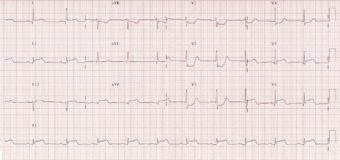 Posterior Myocardial Infarction • LITFL • ECG Library Diagnosis